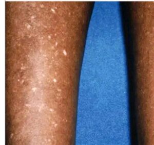 White Spots On Legs: What Causes Them And How To Get Rid Of Them ...